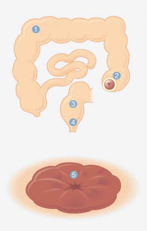 Du och din kolostomi - M Care